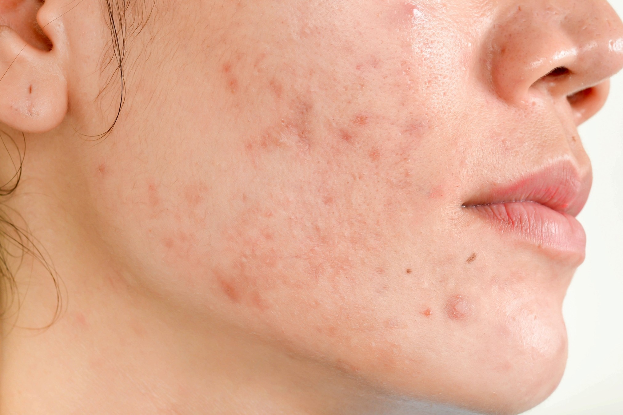 Pigmentation Treatment | A Klinik Penang
