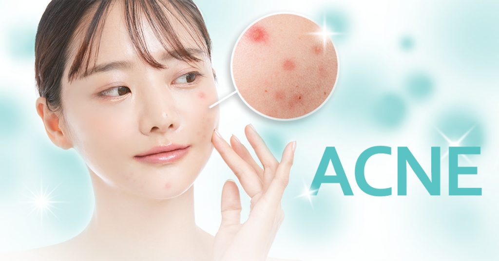 Acne Treatment in KL & Penang | A Klinik Signature