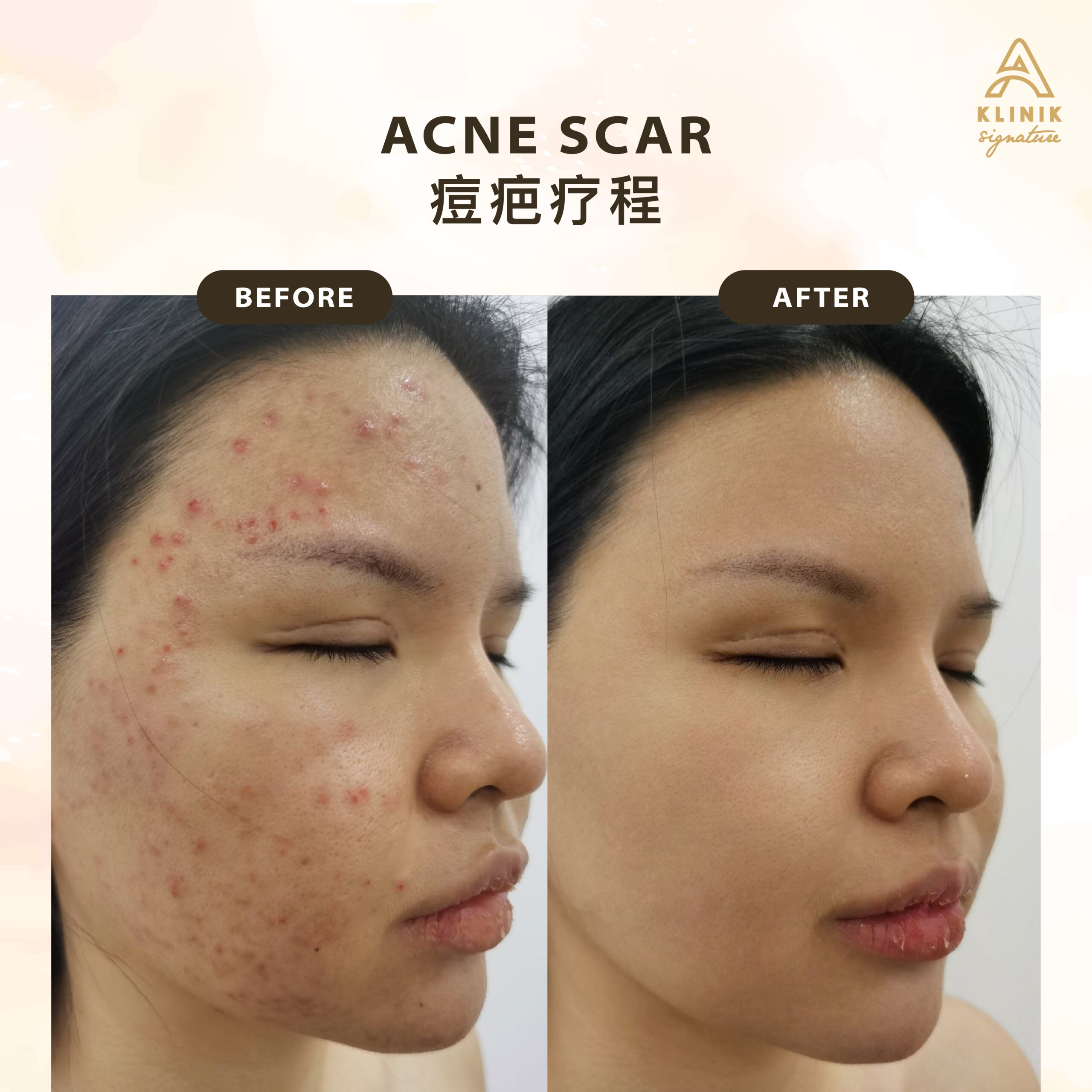 Acne Scars and Pores | A Klinik Signature