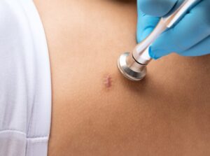 Keloid Removal in KL & Penang | A Klinik Signature