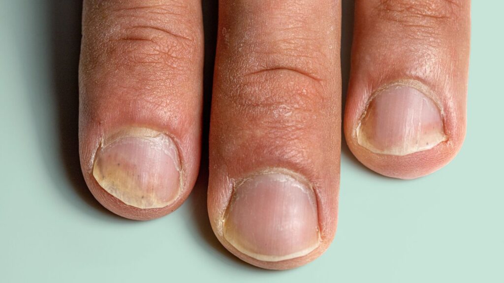Nail Problem in KL & Penang | A Klinik